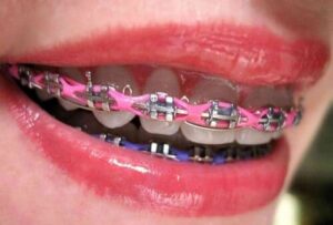 27 Ideas GENIALES para combinar colores de brackets | TodoSobreColores
